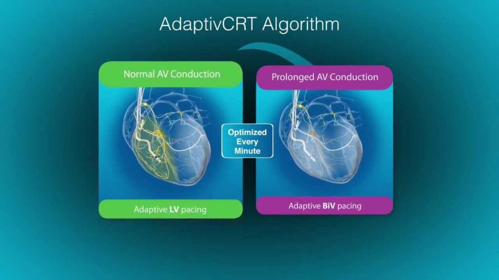 NEW DATA: AdaptivCRT | Defibrillatori e Prodotti Biomedicali LIFE TREE